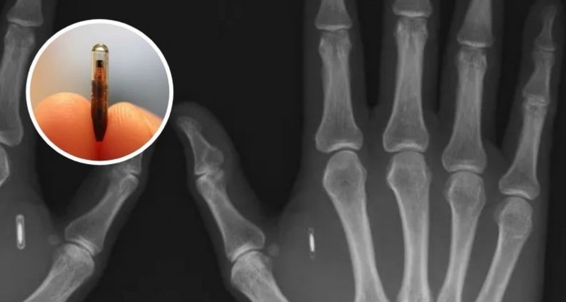 Chip implantado na pele substitui chave e até cartão de crédito e já é ...