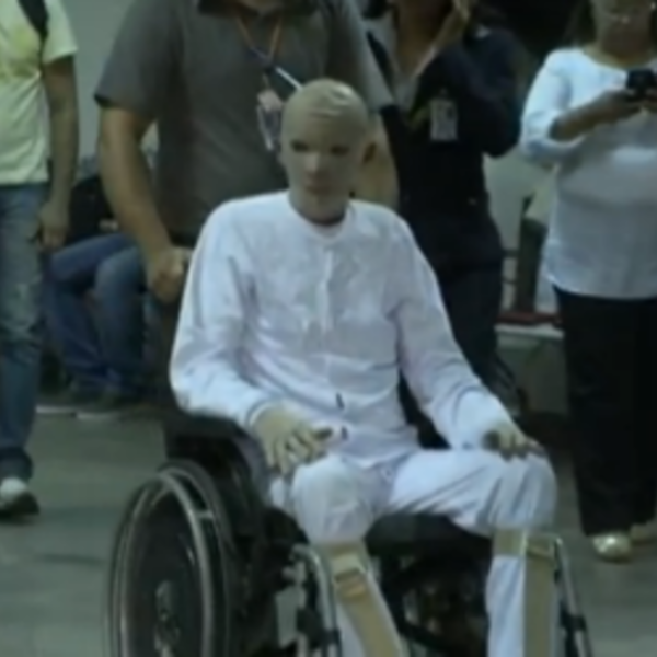 Homem queimado por bandidos ao salvar 2 crianças volta para casa